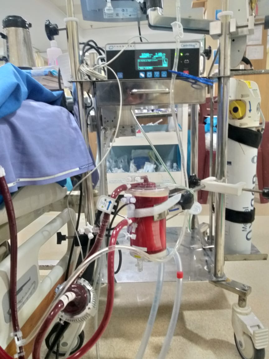 ECMO – THE SAVIOUR SYSTEM IN COVID19 - Kolkata Wire