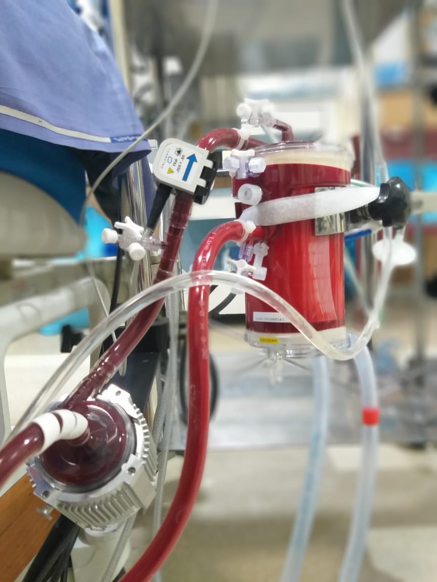 ECMO – THE SAVIOUR SYSTEM IN COVID19 - Kolkata Wire